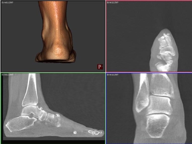 pedCAT Shown to be Most Effective Imaging Option for Mülller-Weiss ...