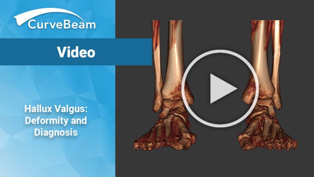 Hallux Valgus: Deformity and Diagnosis - CurveBeam AI