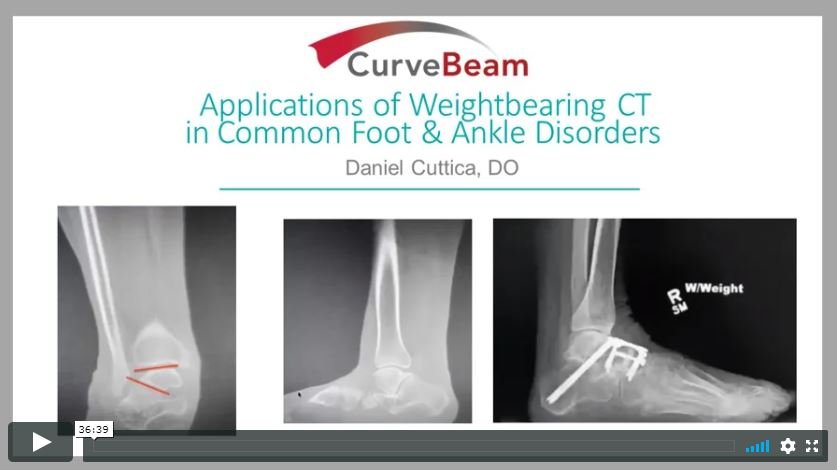FOOTInnovate Webinar Recap: Application of Weightbearing CT (WBCT) in ...